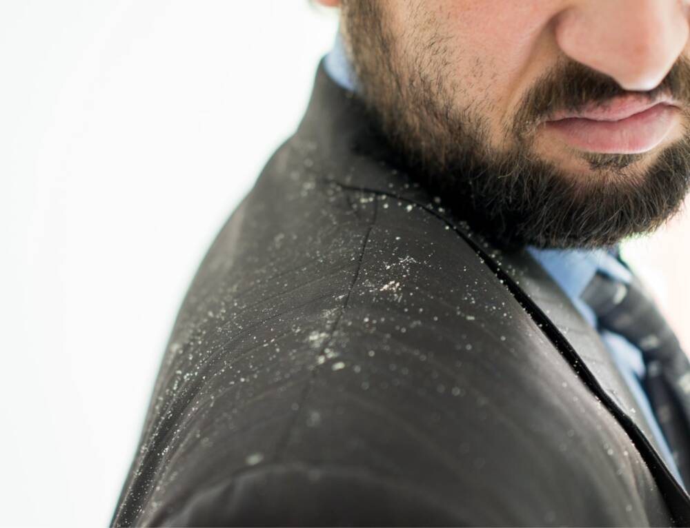 Forfora secca: cause, sintomi e soluzioni efficaci | Galenia