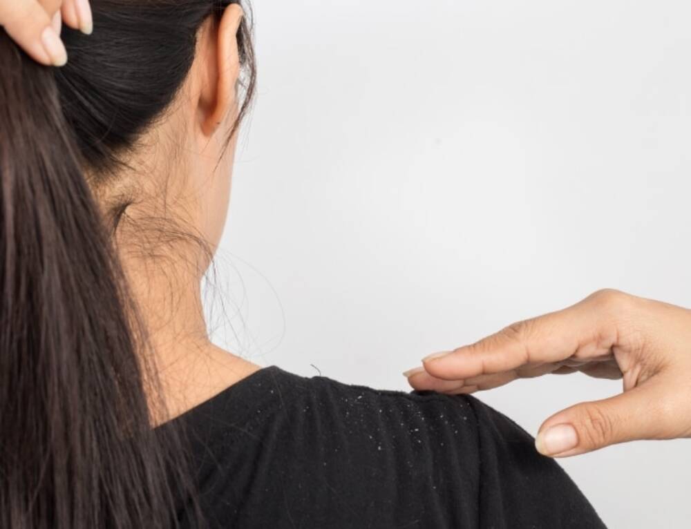 Forfora secca: cause, sintomi e soluzioni efficaci | Galenia